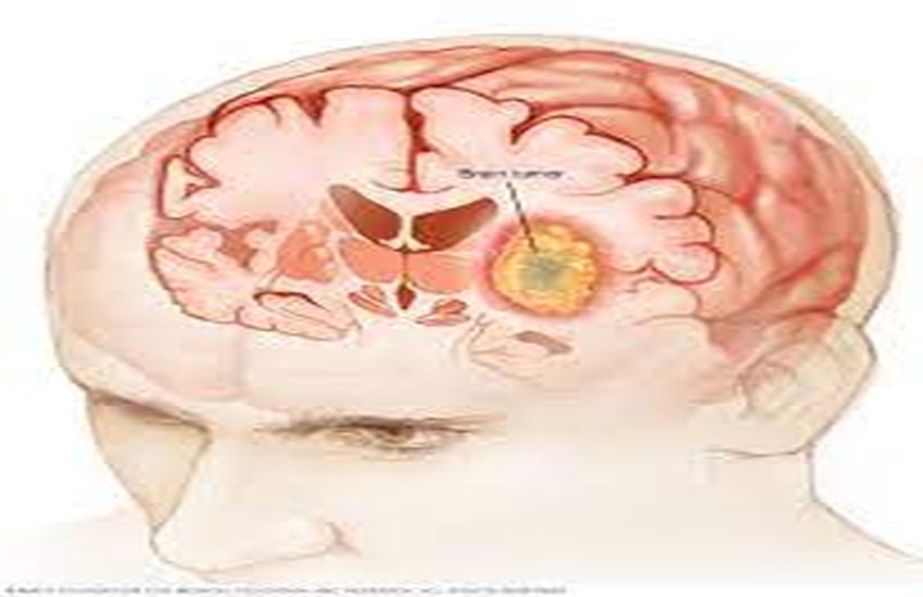 Brain Tumer Is Very Danger ब्रेन ट्यूमर के संकेतों की अनदेखी पड़ सकती